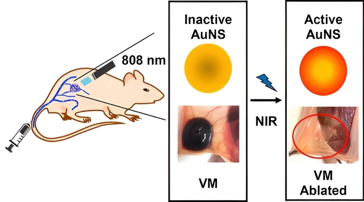 Nanoshells in Photothermal Therapy Target Venous Malformations